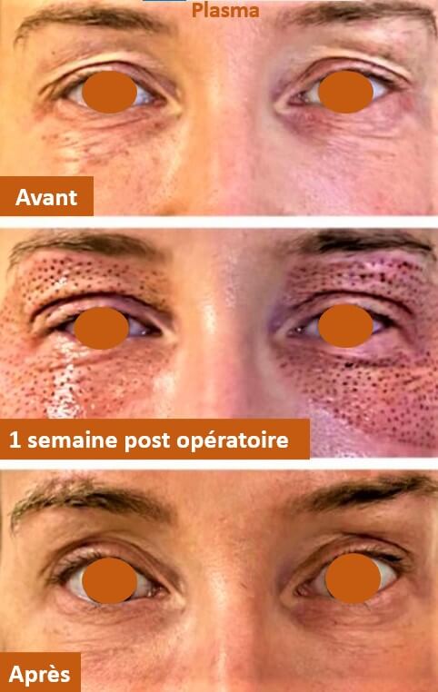 Plasma Lift - Esthetique médical